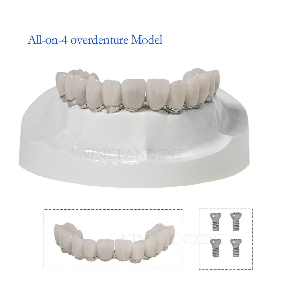 Dental Implant Modle,Lower Upper Jaw,RPD Dentures,Overdenture ...