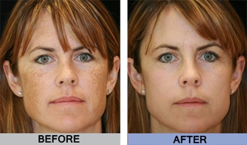 4 oz LACTIC Acid Skin Peel- 25% - For: Acne, Scars, Wrinkles, Melasma ...