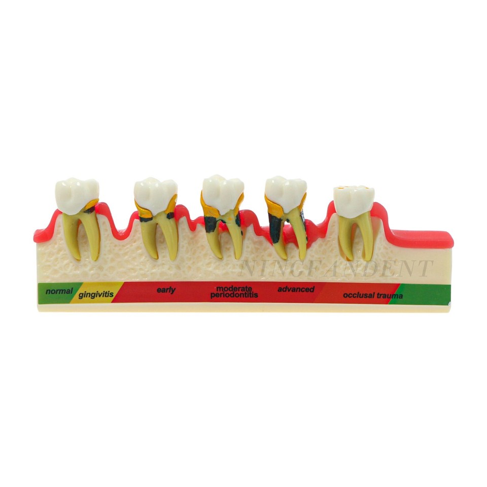 Dental Typodont Periodontal Disease Teeth Model Stage Perio Disease ...