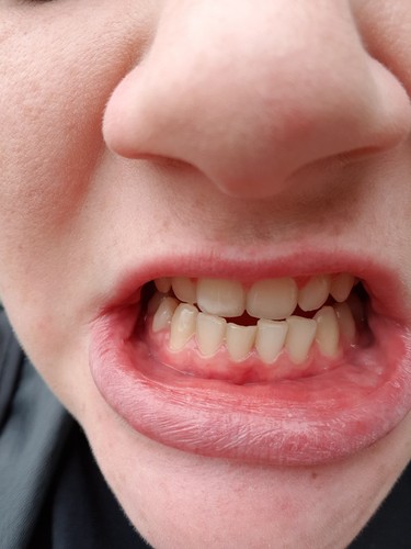 Advanced Teeth Whitening Whitener Bleach White Dental Kit for sale ...