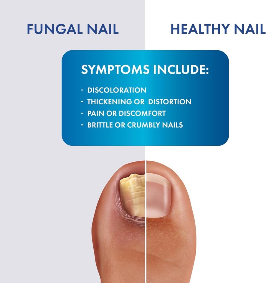 Pro ClearZ Fungal Shield Maximum Strength Brush-On Anti-fungal Liquid 1 ...