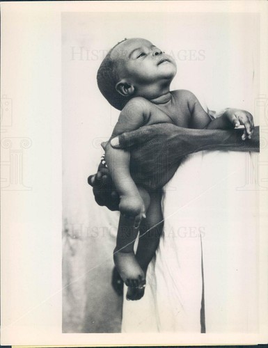 1964 Press Photo Naimey Niger Baby with Cerebrospinal Meningitis ...