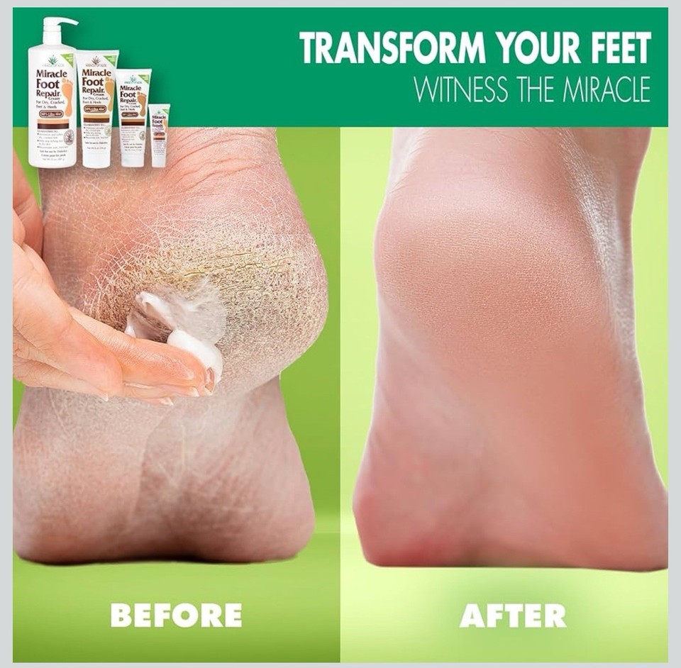 Miracle Foot Repair Cream For Dry Cracked Feet 8 Oz Each (PACK Of 2) | eBay