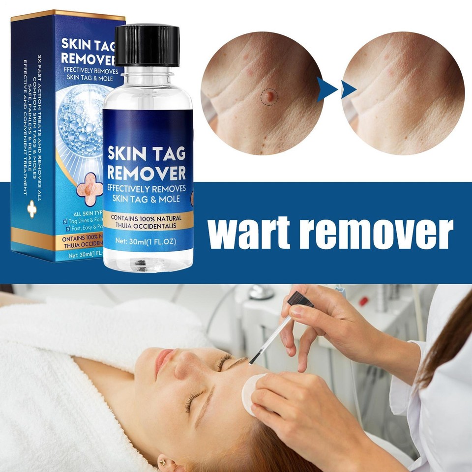30ml Wart Remover Liquid Painlessly Skin Tag mole Remover | eBay UK
