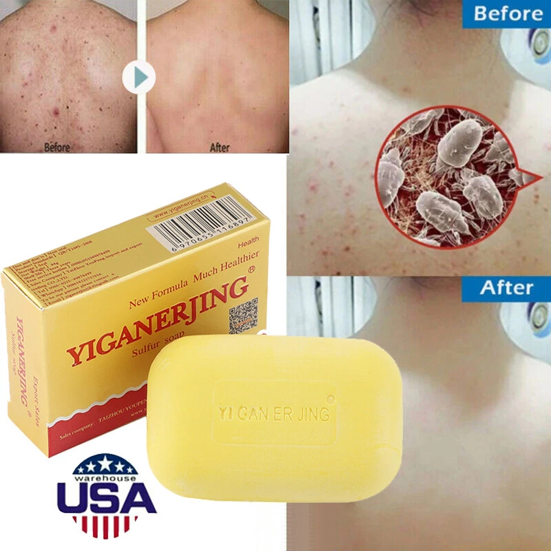 Sulfur Soap Before And After