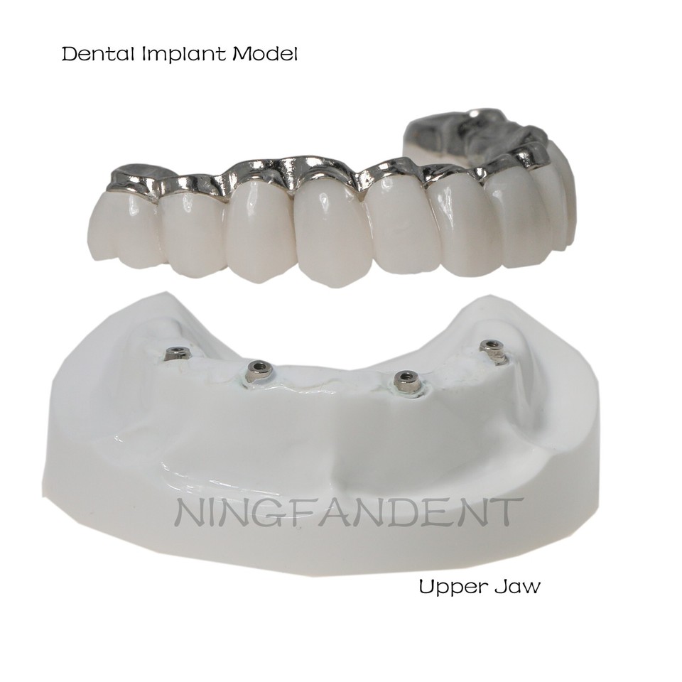 Dental All-On-4 Overdenture Implant Model Upper Pure Titanium Bridge, 4 ...