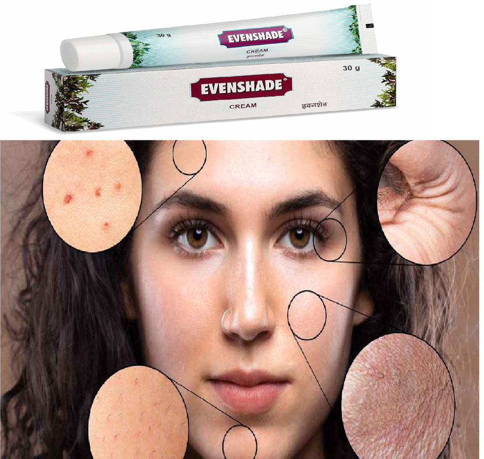 Ayurvedic Melasma Treatment Cream skin pigmentation like melasma ...