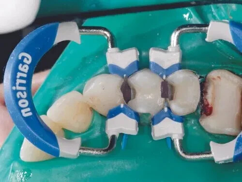 Garrison Dental Composi-Tight 3D Fusion Matrix Rings,Free Shipping ...
