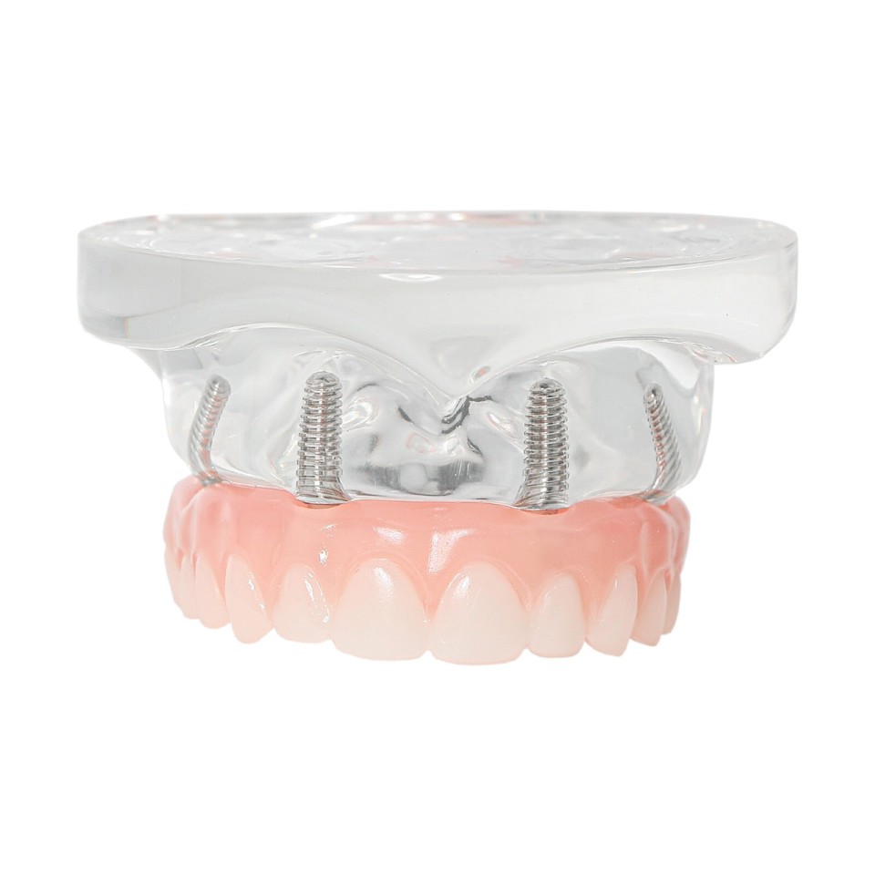 Dental Crown Restoration Model Demonstration With Partial Denture Tooth ...