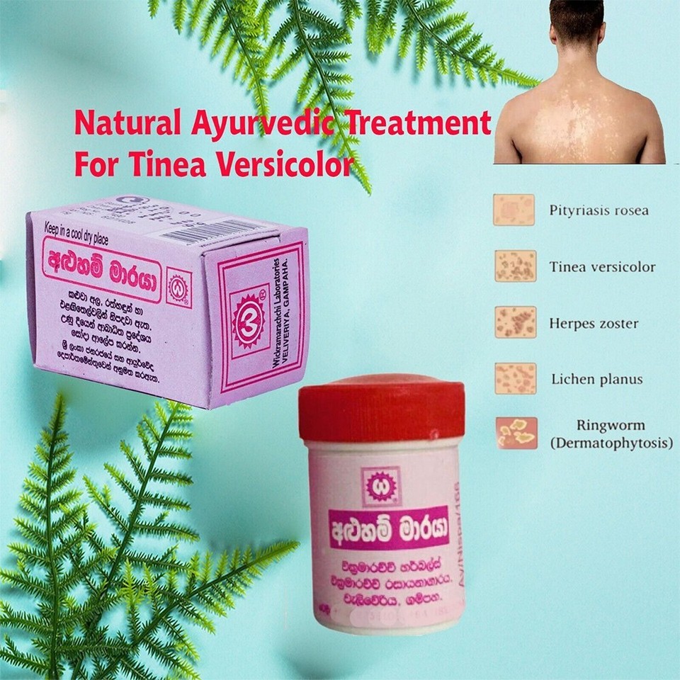 Tinea Versicolor Antifungal Cream Natural Tinea Treatment Cream FAST ...