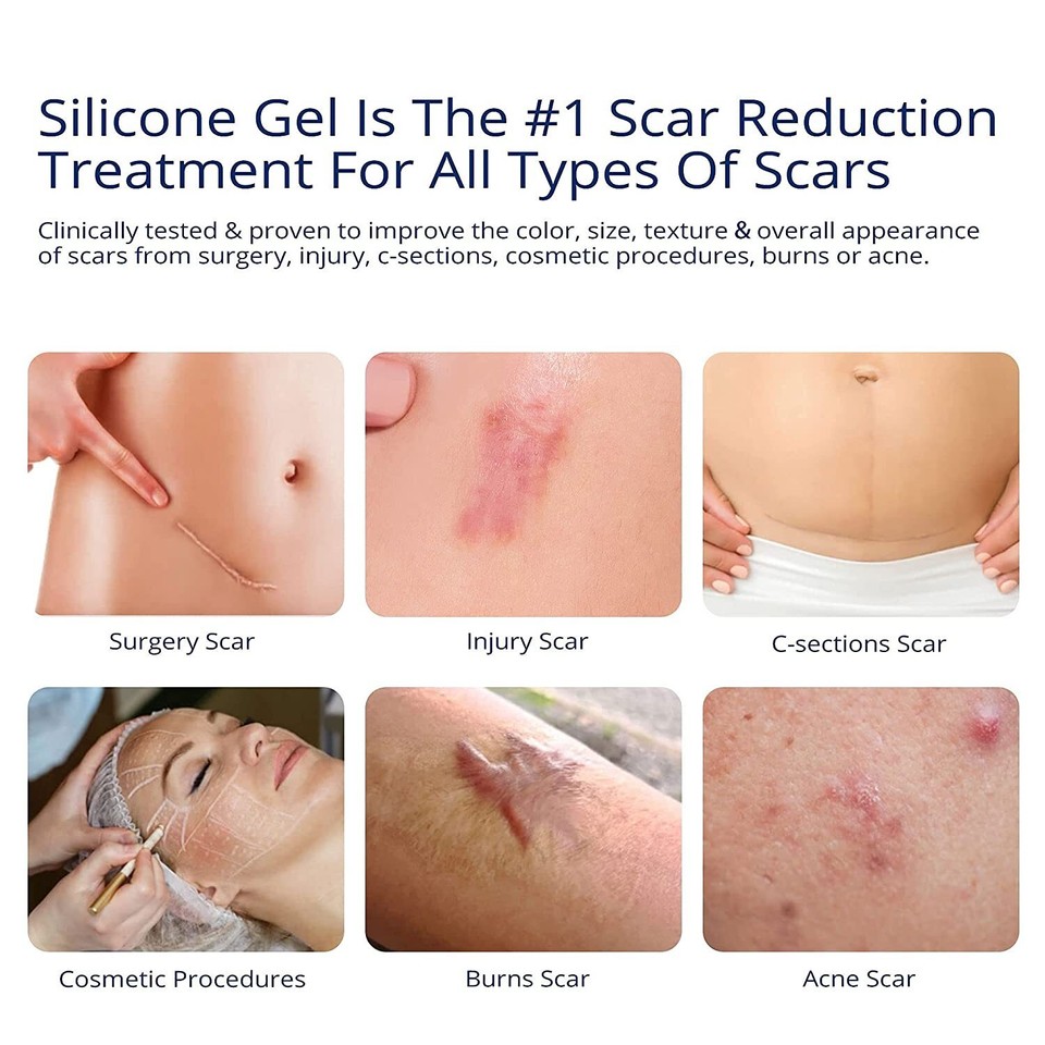 Advanced Scar Gel Effective for C-Section, Stretch Marks, Acne, Surgery ...