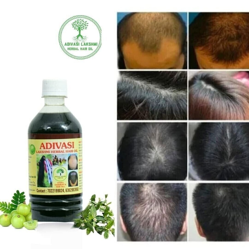 DHT Blocker Hair Loss Oil 3.4 oz, Active Formula For Hair Growth With ...
