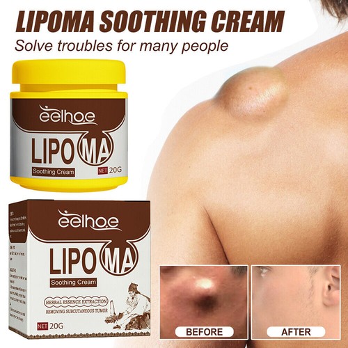 Lipoma Soothing Cream Solve Trouble Skin Swelling Pain Relief Herbal ...