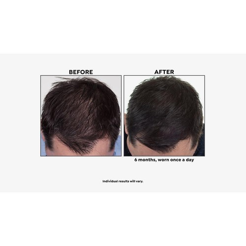 Capillus 82 Laser Hair Growth Therapy Cap for sale online | eBay