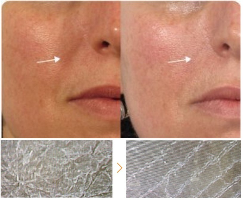 GLO ME Face Diamond Portable Peeling Device Microdermabrasion for ...