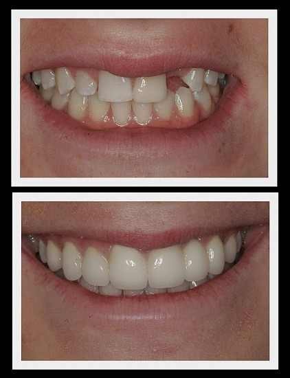 Tooth Fairy RenewaSmile Temporary Tooth Replacement Kit –Make 25 Teeth ...