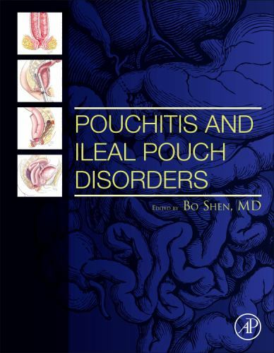 Pouchitis and Ileal Pouch Disorders : A Multidisciplinary Approach for ...