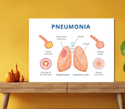 Pneumonia & Healthy Lung Anatomy 5mm thick Plastic Poster Ready to Hang ...