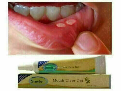 5 X Oral Liquid 10ml Teething Mouth Ulcers Denture Sores Numbing Pain ...