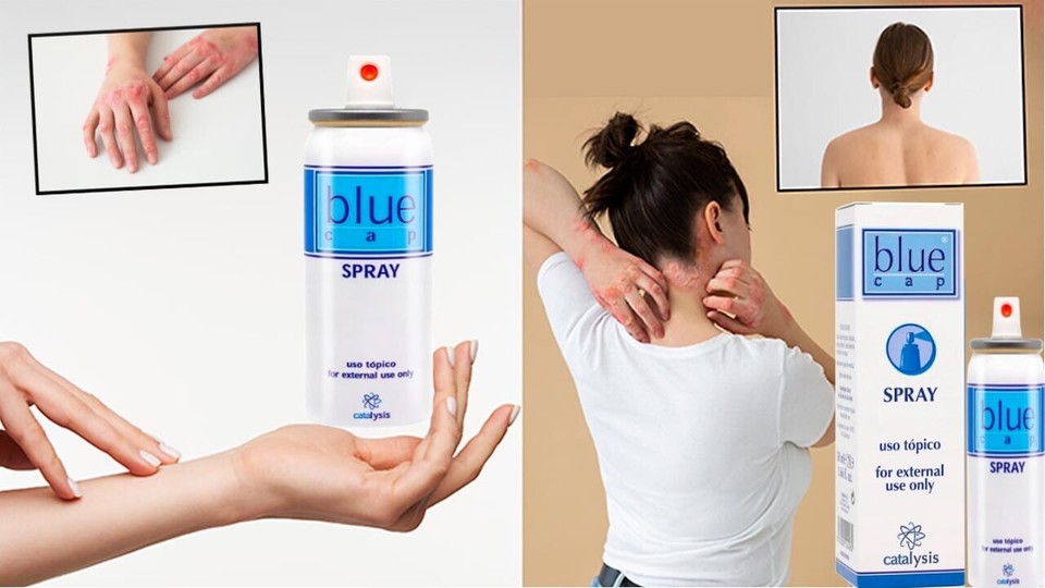 Blue Cap Spray 100ml _____ Bundle Psoriasis Seborrhea Eczema Bluecap | eBay
