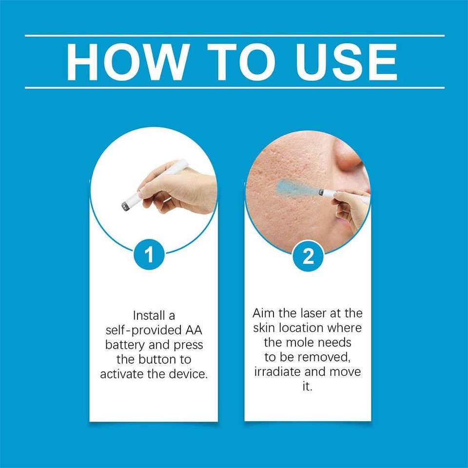 Blue Light Mole Removal Pen Dark Spot Wart Tag Remove Skin Care ...