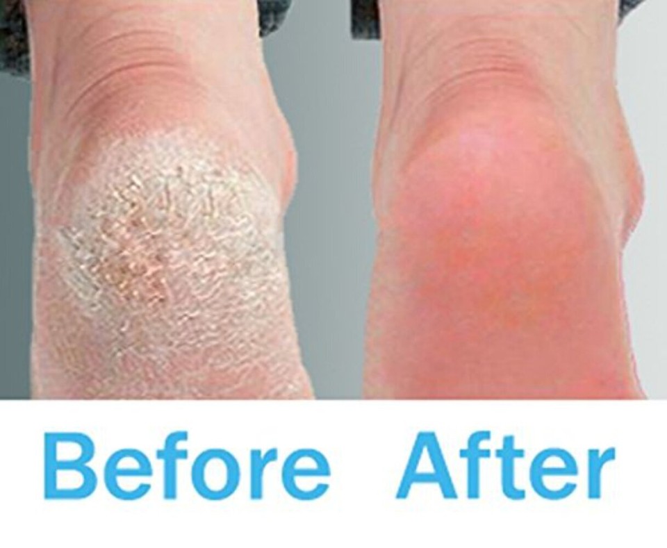 PURSONIC Black Battery Operated Callus Remover, Foot Spa and Foot ...