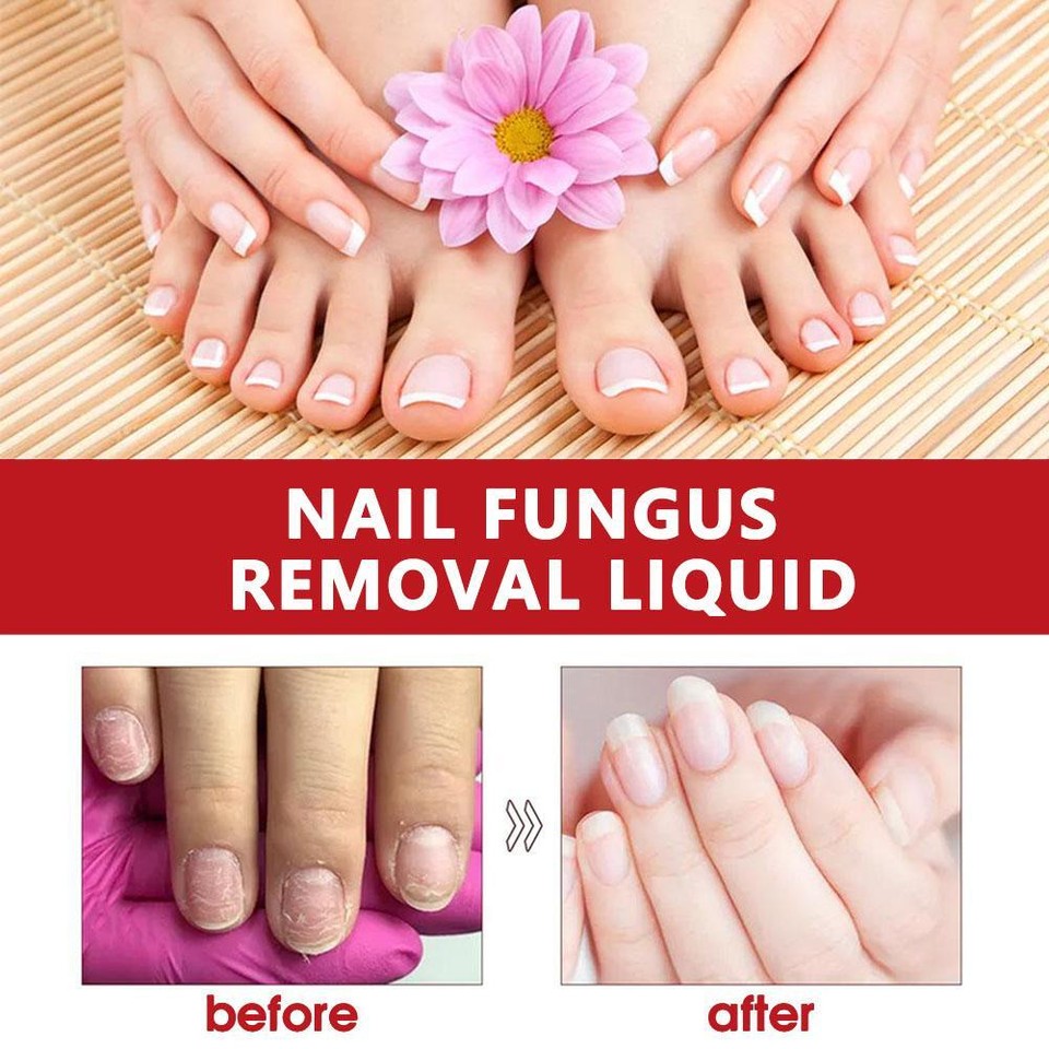 Nail Fungus Liquid Fungal Infection Nails Treatment Feet Anti Removal ...