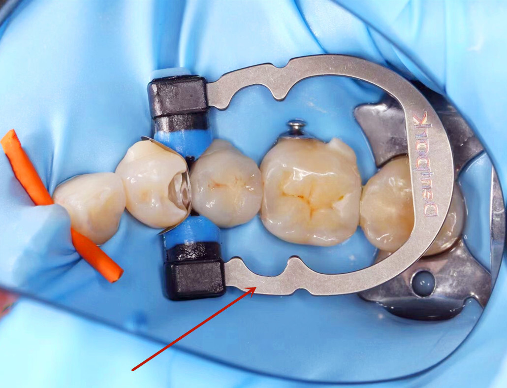 1 Piece Dental Titanium Alloy Ring Matrix Clamp Clip Fits Garrison Blue ...