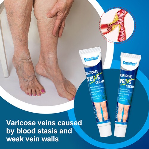 Varicose Veins Treatment Cream Vasculitis Phlebitis Spider Cream ...