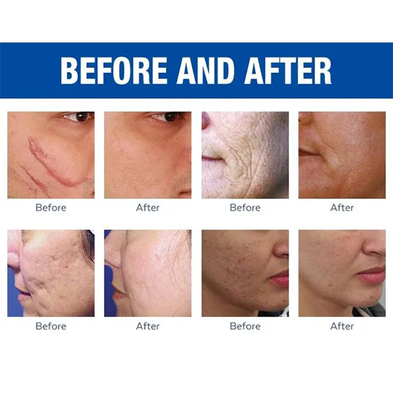 Co2 Fractional Skin Rejuvenation Laser Acne Scar Stretch Marks Removal ...