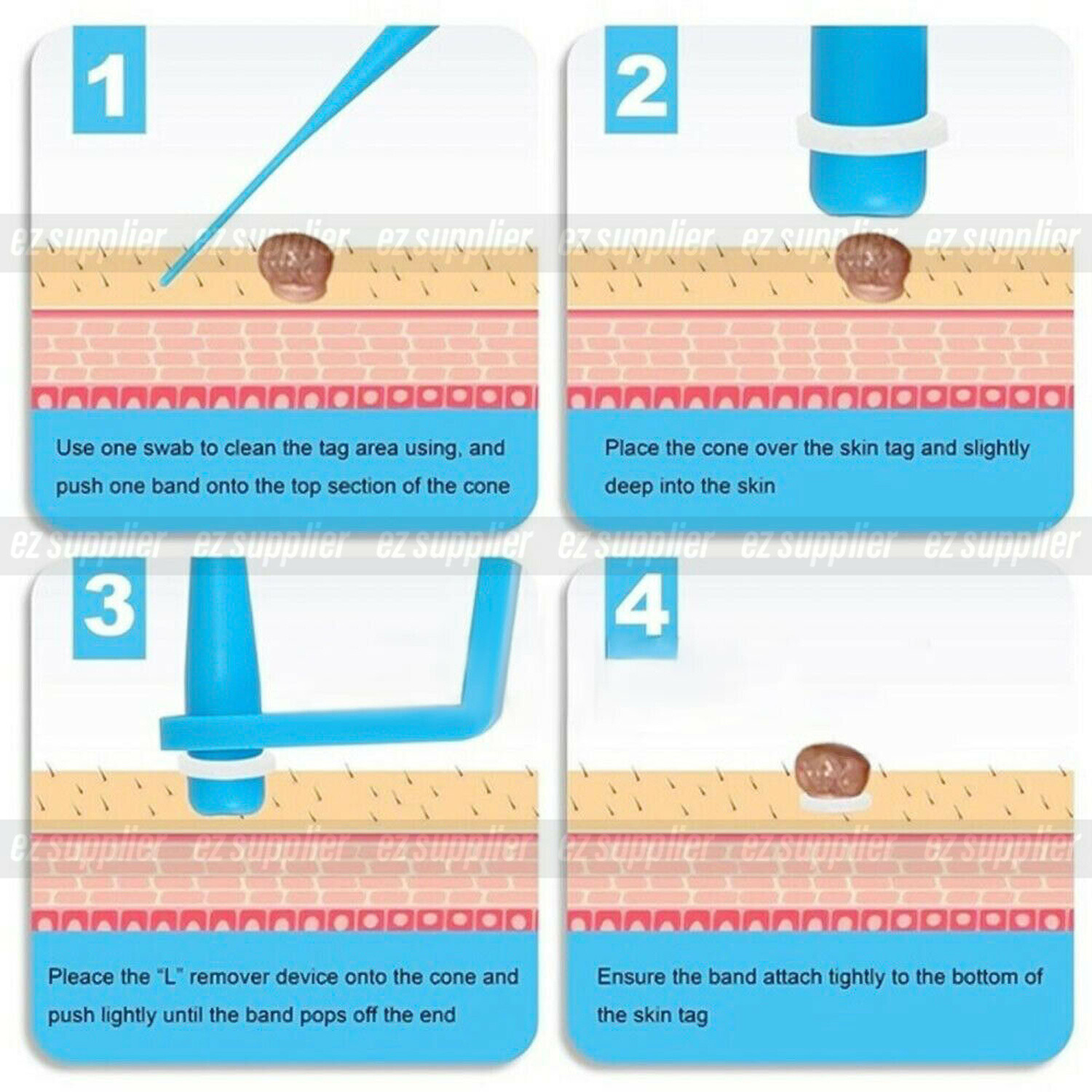 Skin Tag Remover Kit for Fast & Effective Skin Tag Removal HOT | eBay ...