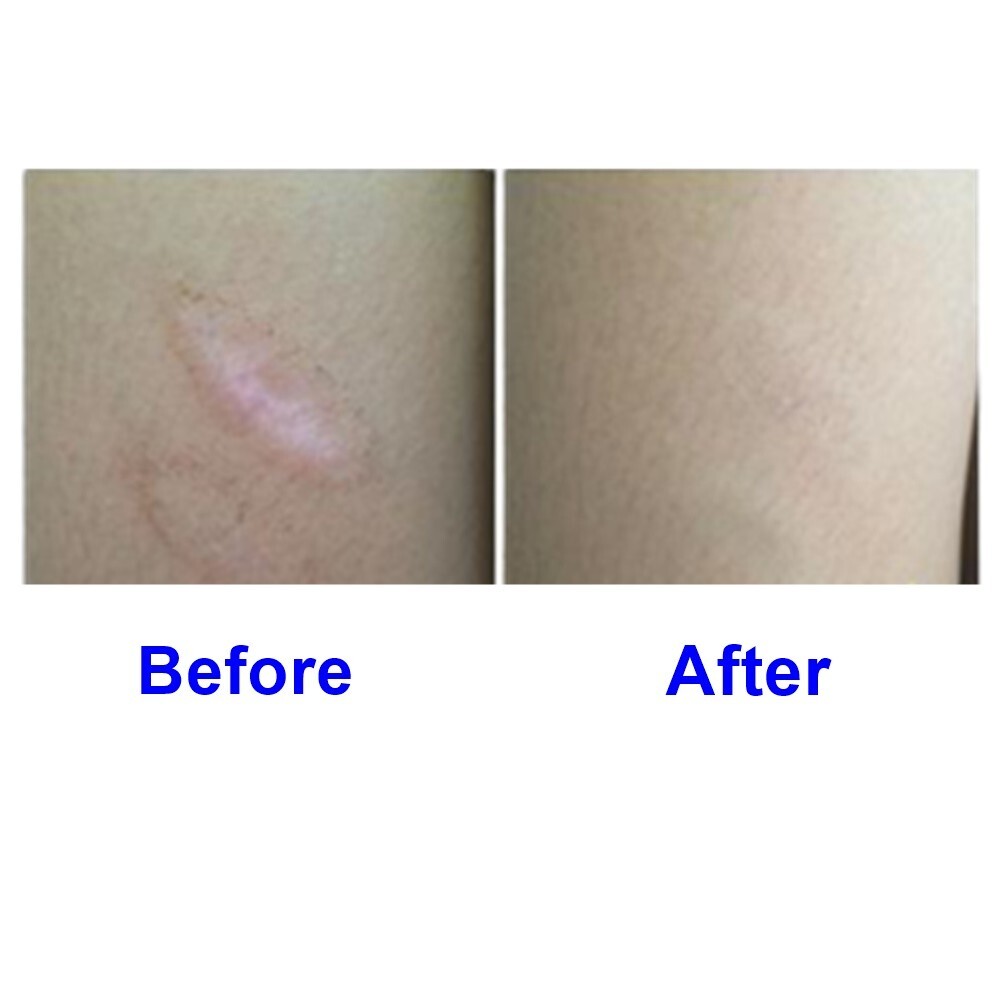 Cream Hirudoid Relieves Scars Bruises Varicose veins Skin Inflamed 10 ...