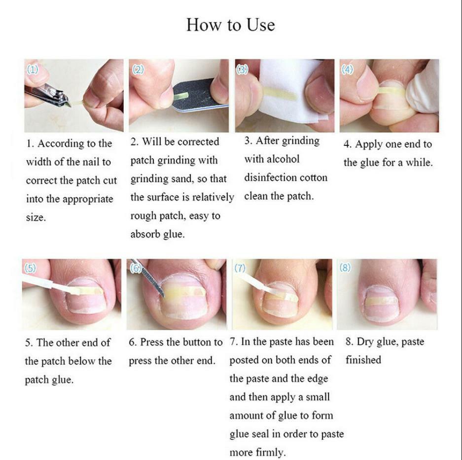 10Pcs Ingrown Toe Foot Nail Correction Sticker Pedicure Tool Toenail ...