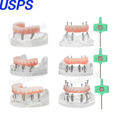 US Dental Implant Model Overdenture Upper Lower Jaw 4/6 Screws Post ...