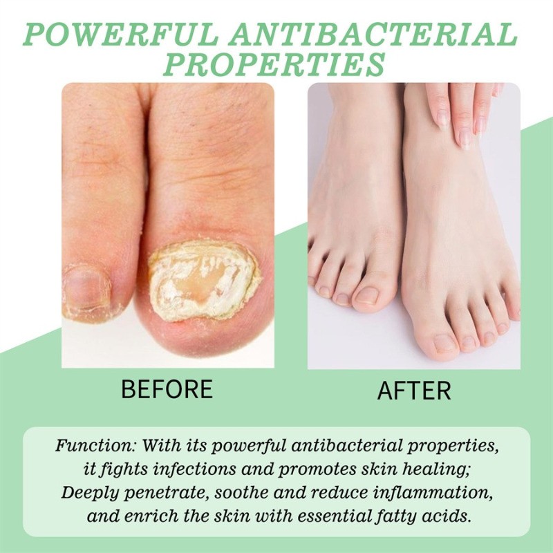 Nutraboost Nail Fungus Treatment Gel, Nail Fungus, Fungus Cream 2025 ...