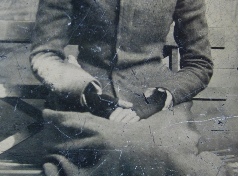 WEIRD Tintype Photo - Woman with DEFORMED Arm- Cast? 1880s medical ...