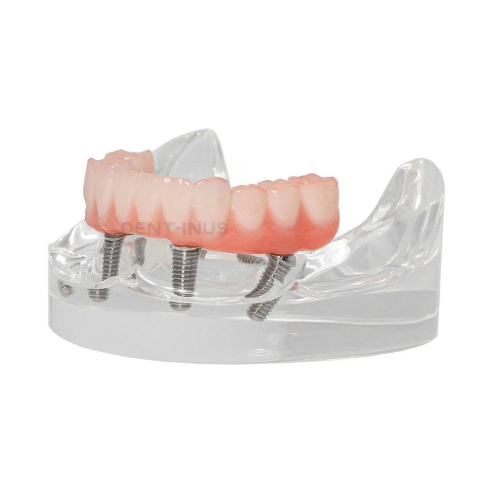 Dental Laboratory Typodont Teeths Teeth Dental Implant Modle,Lower ...