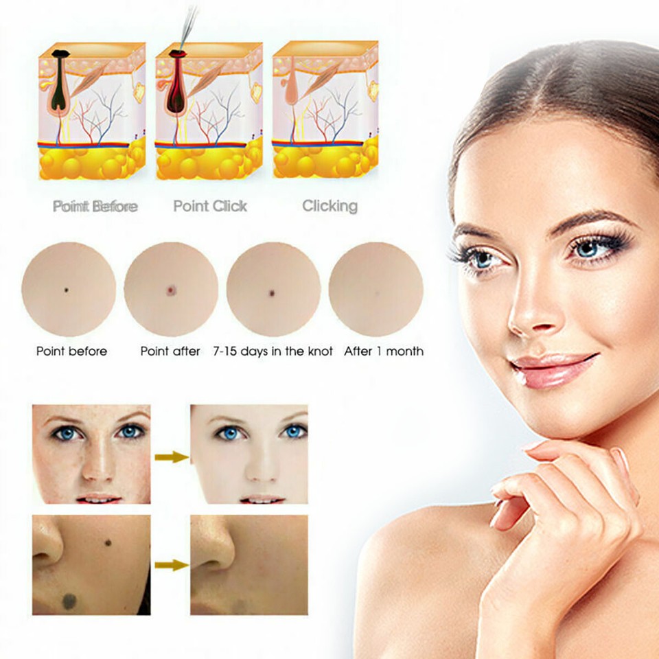 Anti-Aging Laser Plasma Pen Skin Wart Tag Tattoo Mole Removal Dark Spot ...