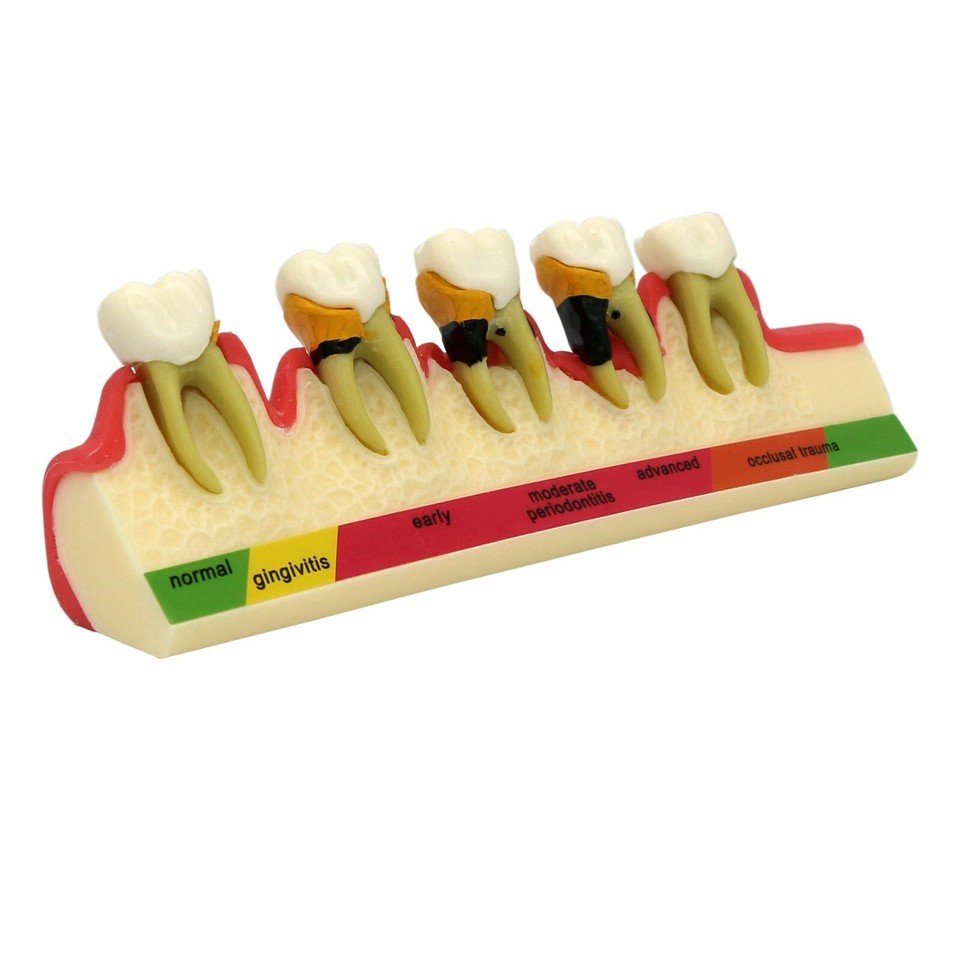 Dental Pathological Typodont Teeth Model Periodontics/Implant ...