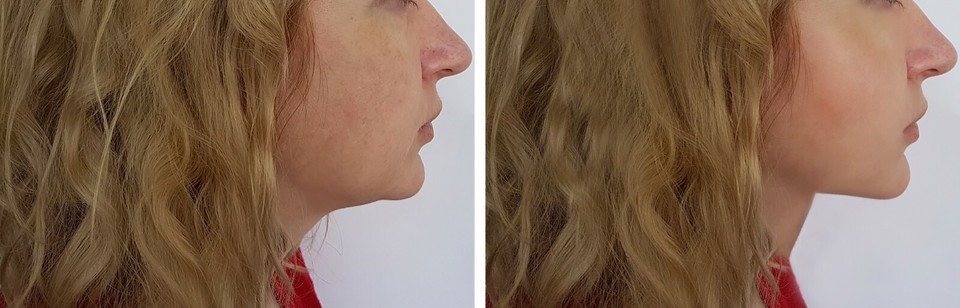 Double Chin Reducer Chin Up Wrap Applicator Mask It Works For Natural ...