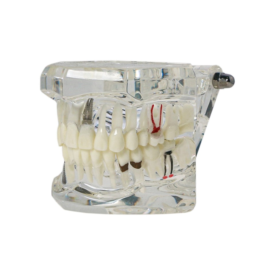 Dental Teeth Model Ortho Practice Teaching Demo Periodontal Disease ...