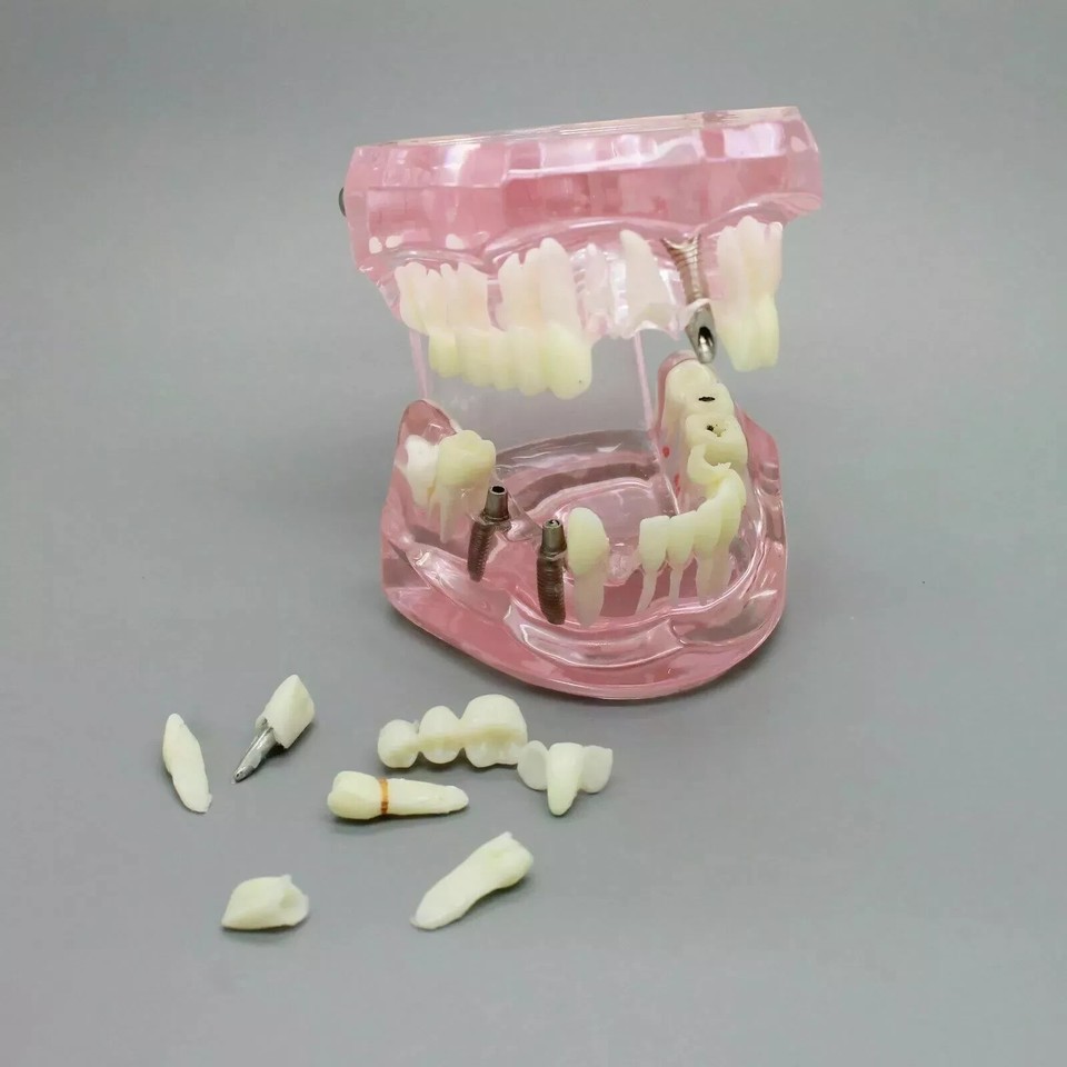 Dental Typodont Teeth Model Ortho Implant Pathological Perio Practice ...