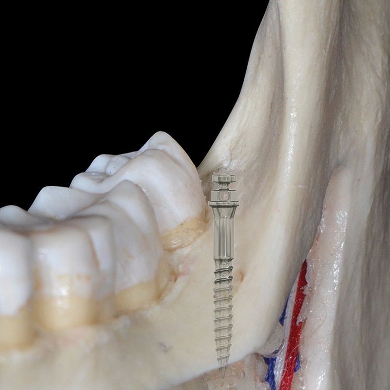 1x Dental Orthodontic Buccal Shelf B0ne Mini Screw Ø2.0mm L14, L16mm ...