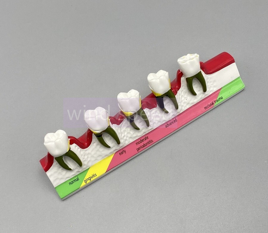 Dental Study Teaching Model Periodontal Disease Assort Teeth Dentoform ...