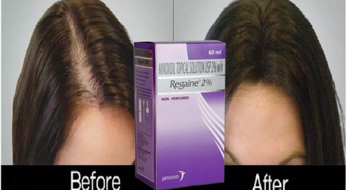 2 Pack-Regaine Topical solution 2% For Women Hair Loss & Regrowth ...