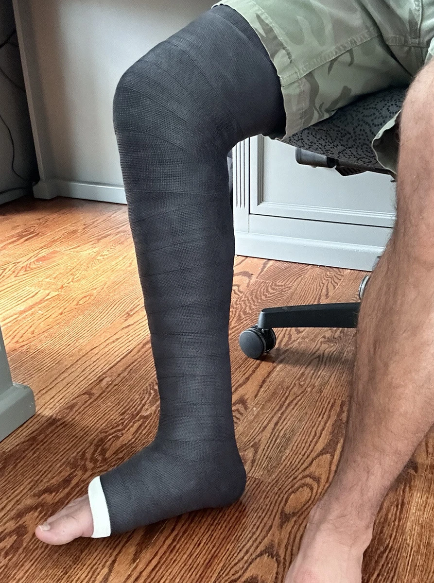 Broken Femur Cast