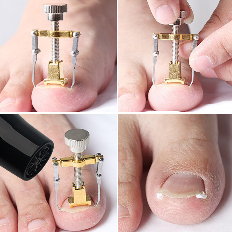 Ingrown Toe foot Nail Correction Fixer Nail Pedicure Tool Toenail ...