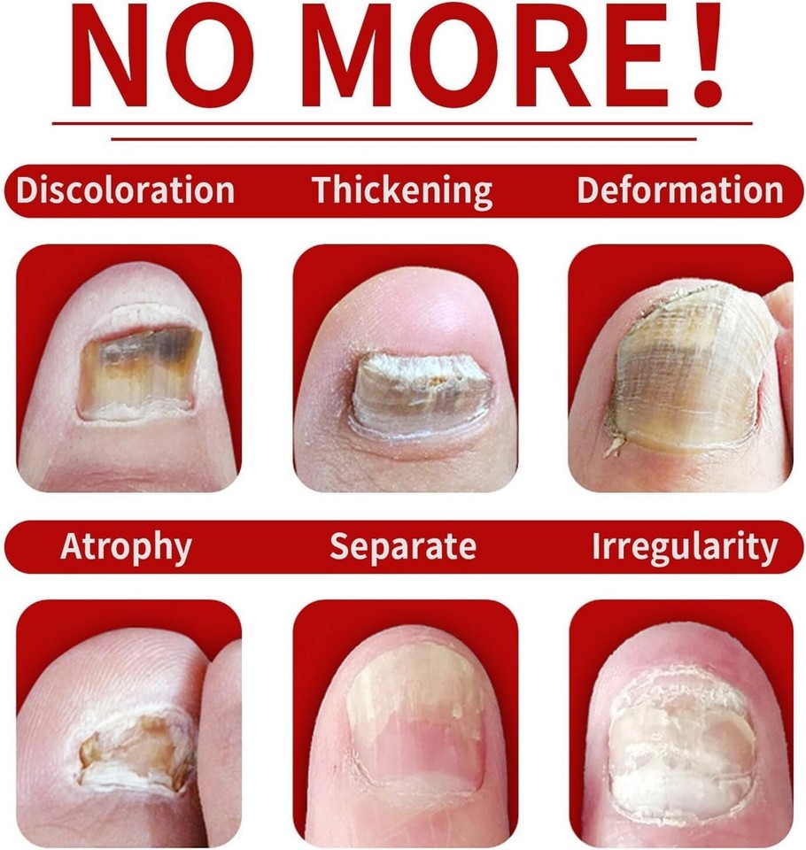 Fungal Nail Treatment - Extra Strong Nail Fungus Treatment for Toenail ...