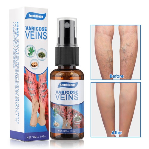 2Pcs VeinFix Varicose Treatment Spray Veinhealing Varicose Veins Treatment Spray | eBay