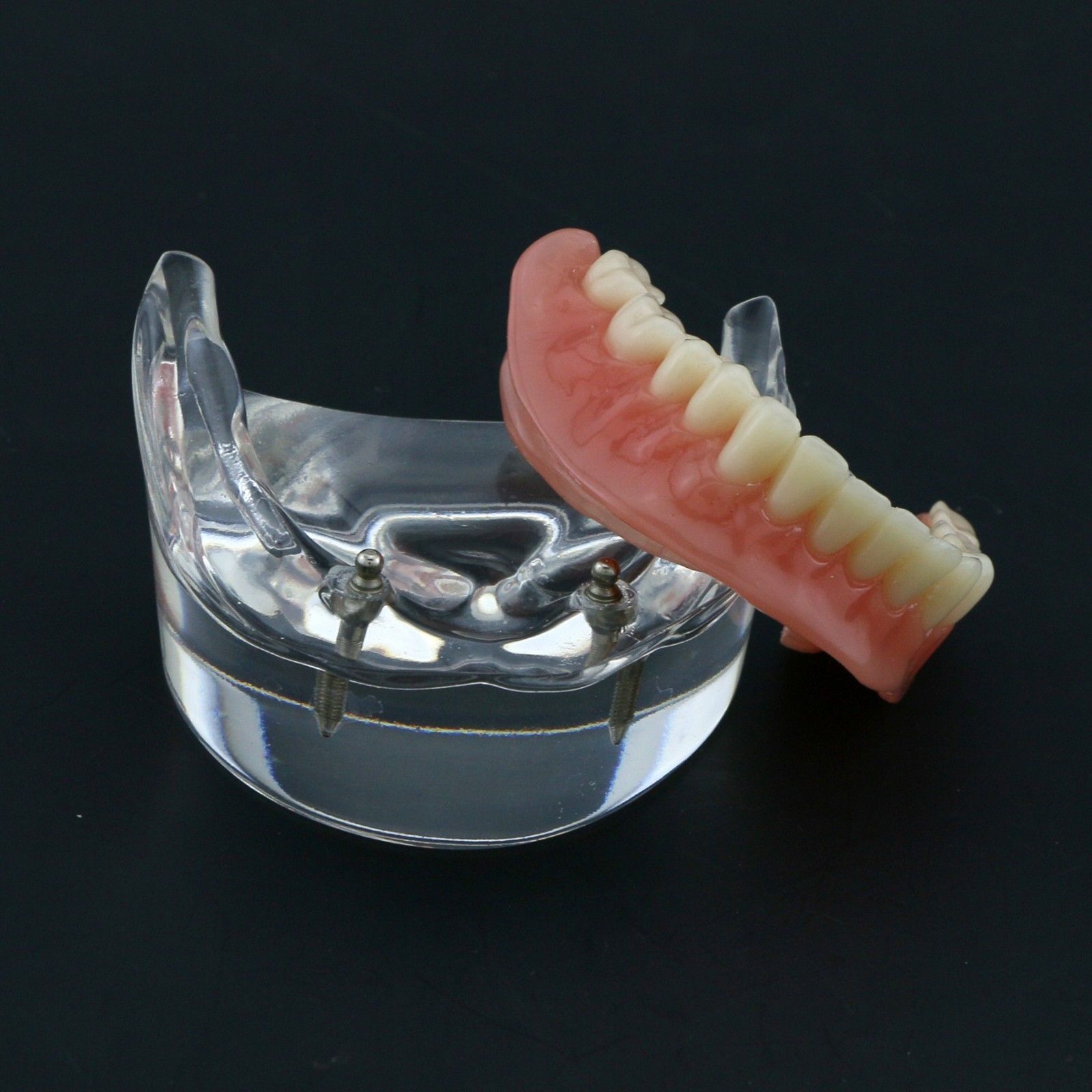 Dental Implant Model Demo Overdenture Restoration with 2/4 Implants ...